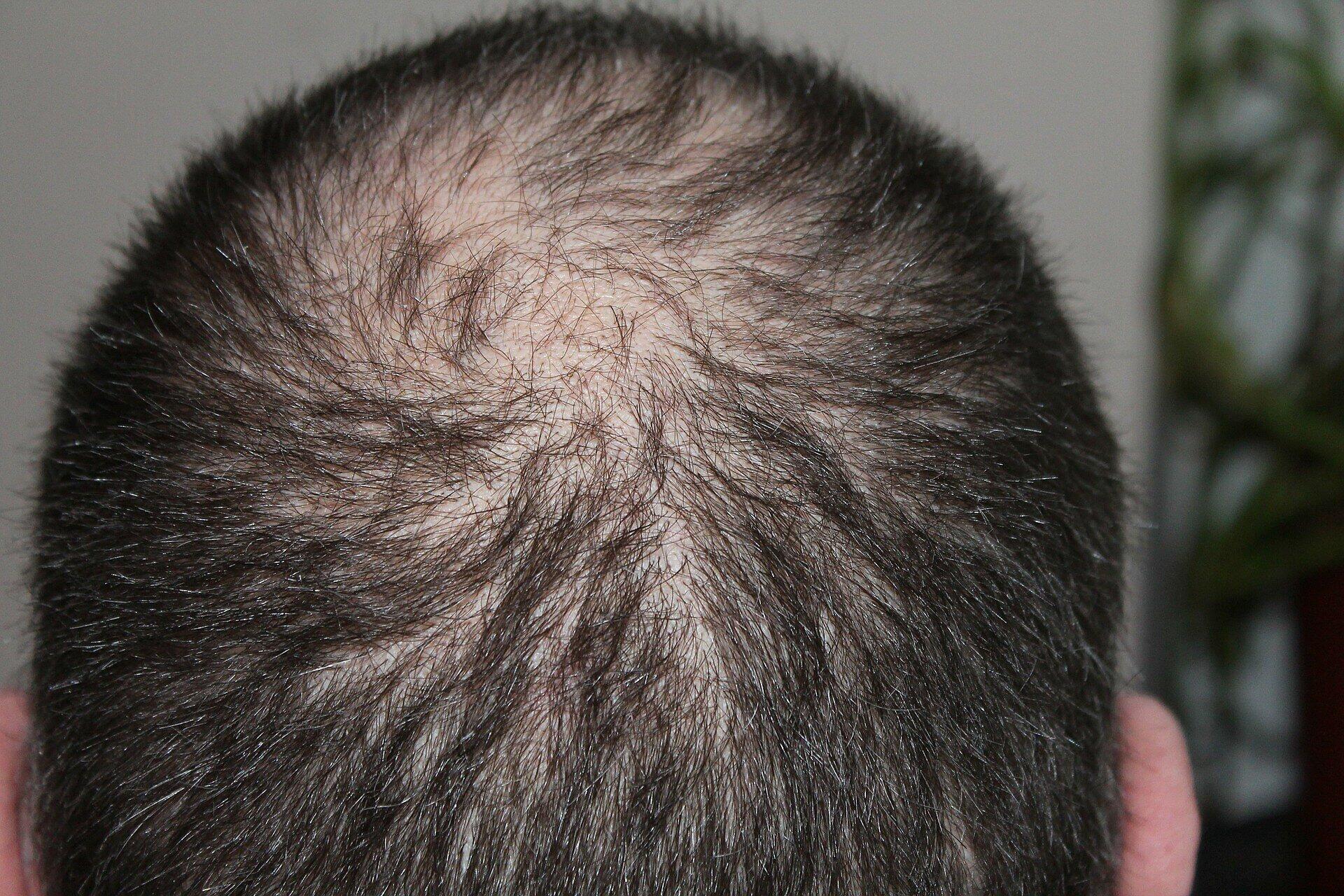 Schüttes und lichtes Haar: Was hilft wirklich gegen Haarausfall?