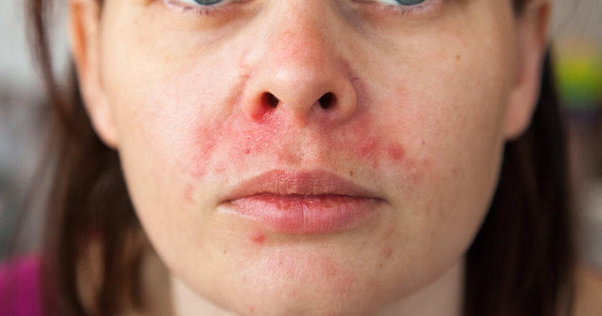Rote Flecken um Mund und Nase: Das steckt hinter einer perioralen ...