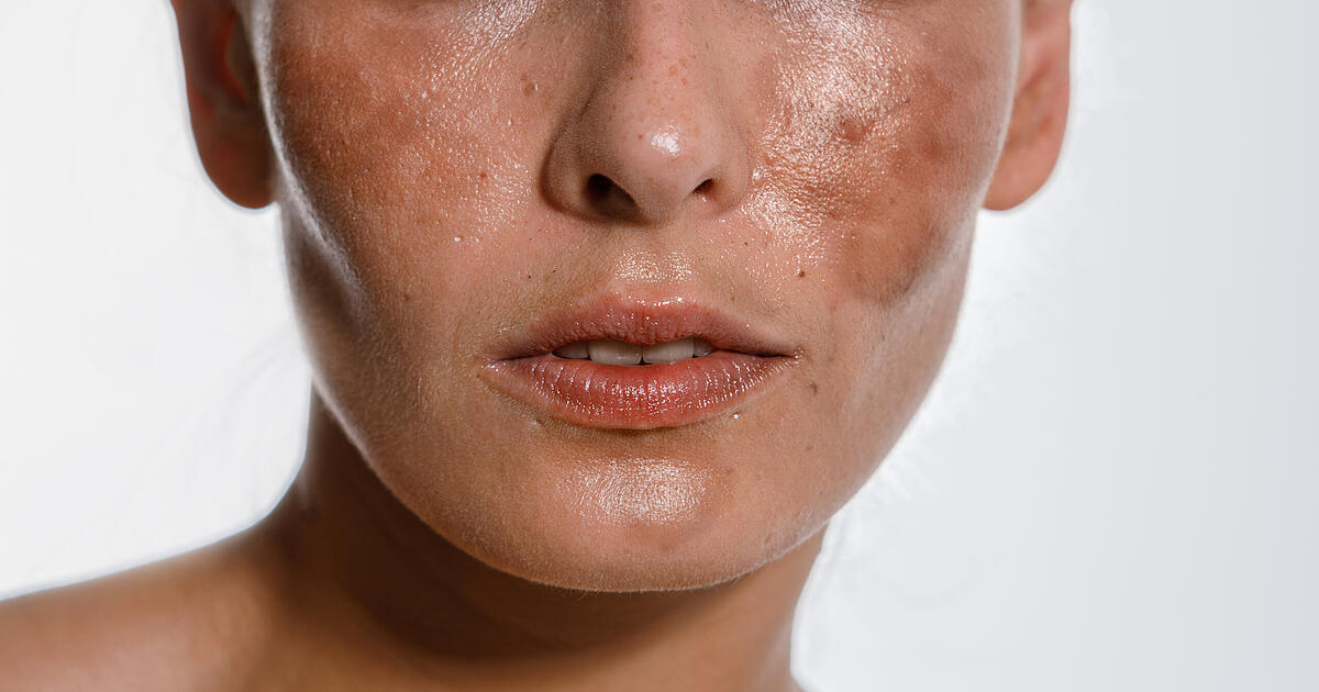 Erkenne Morbus Addison: Symptome und Risiken der Bronzekrankheit