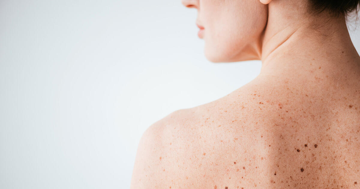 Pergamenthaut-Verdacht: Symptome, Ursachen und effektive ...