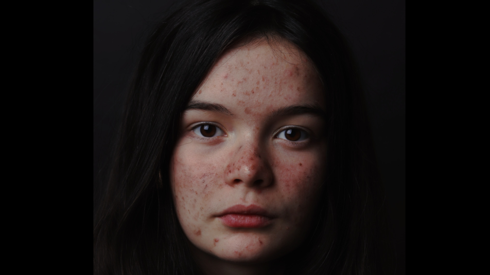 Face-Mapping: Was dir Pickel über deine Gesundheit verraten